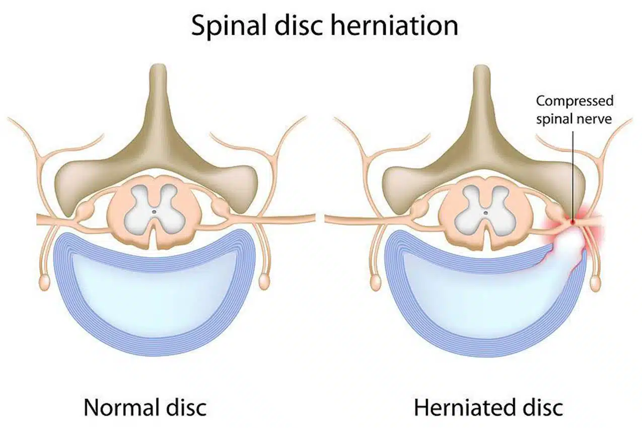 Herniated Vs. Bulging Discs | Chiropractic Insights Omaha